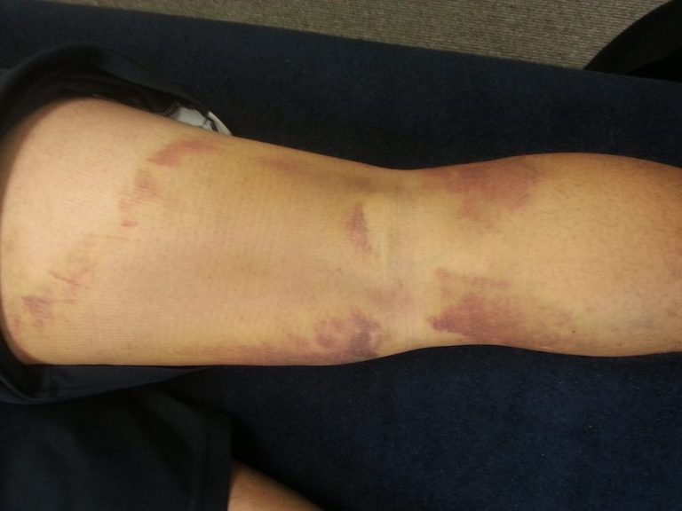 Hamstring, Tears and Strains - Lexington Health